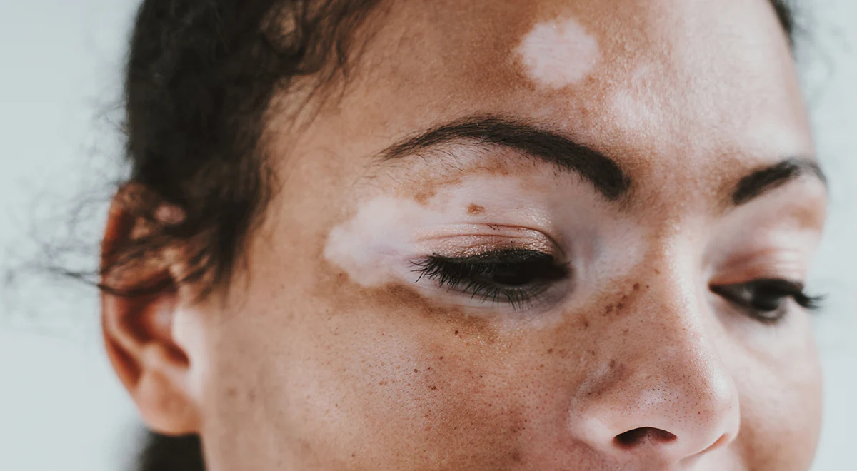 Vitiligo: What Is It, Causes, Symptoms and Treatment